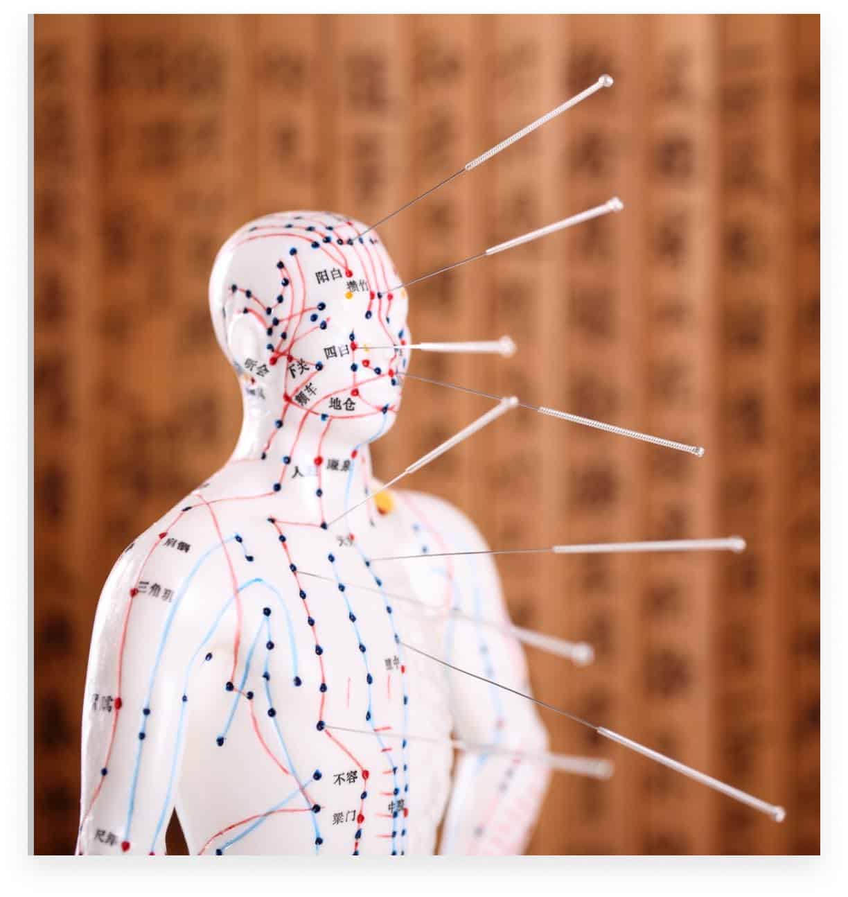 Acupuncture in Brisbane with Trent Dolman